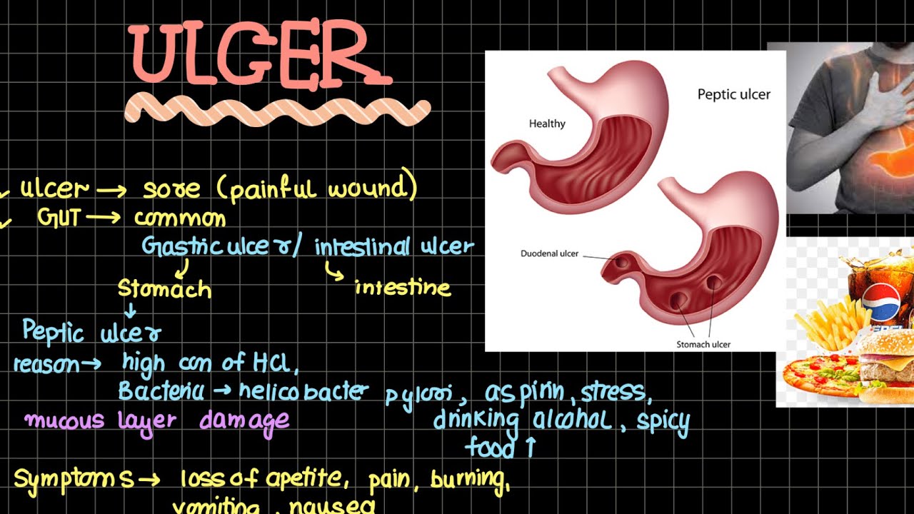 Peptic Ulcer | Digestive System Diseases | chap-Digestion | Class 11,12 ...
