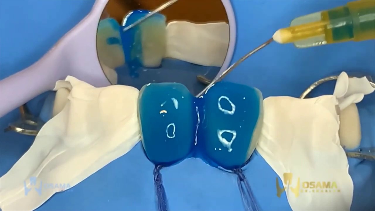 diastema closure with composite resin - YouTube