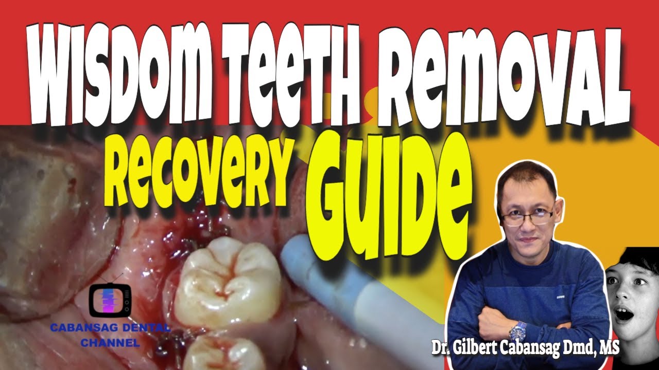 Wisdom teeth removal: Recovery Guide(Paano mabilis gumaling) - YouTube