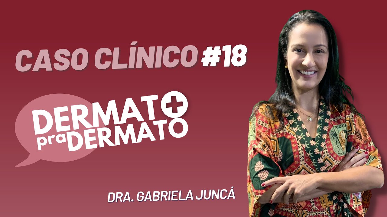Dermato pra Dermato #18 - Caso Clínico - YouTube