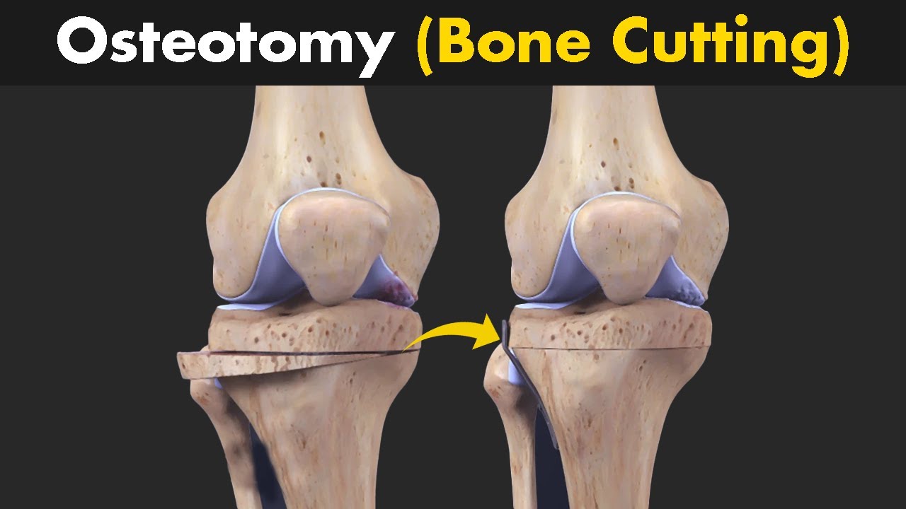 How Osteotomy is Performed? : Surgical Cutting & Realigning or Removing ...