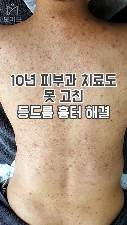 10년 피부과 치료도 못 고친 등드름 흉터 해결 건대 피부관리 모아드 Youtube