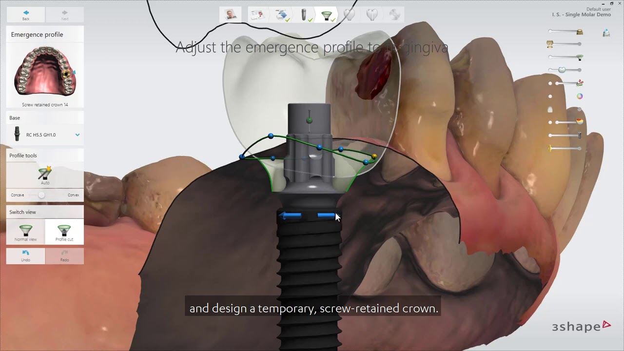 Same day implant dentistry with 3Shape Implant Studio 2019 - YouTube