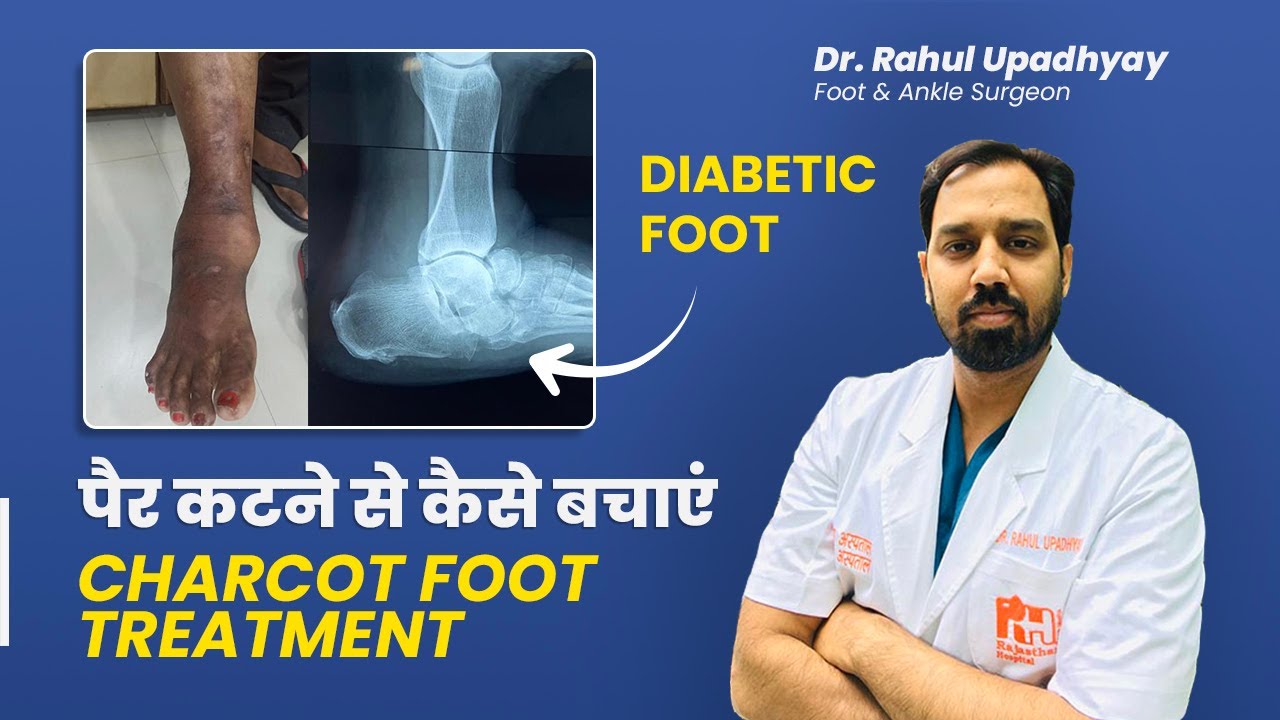 Diabetic Foot Treatment | Charcot Foot | पैर कटने से कैसे बचाएं ? | Dr ...