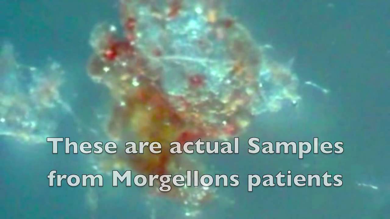 MORGELLONS Real or Delusion? Under the Microscope - YouTube