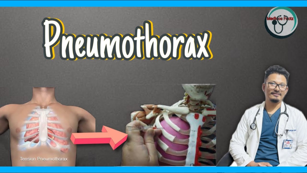 Pneumothorax Explained: Emergency Needle Decompression on a Real ...
