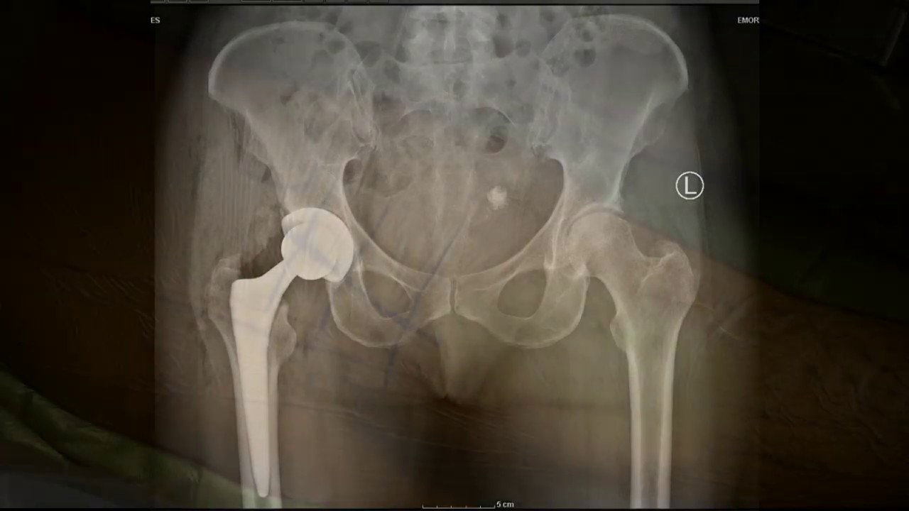 Klassic HD® Anterior Approach THA with Dr. George Guild - YouTube