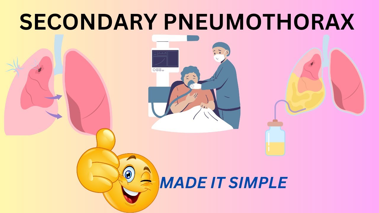 Secondary Pneumothorax - causes, symptoms, diagnosis, treatment ...