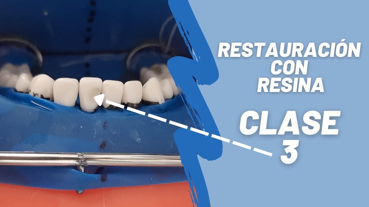 Restauración con Resina -Clase 3 - YouTube