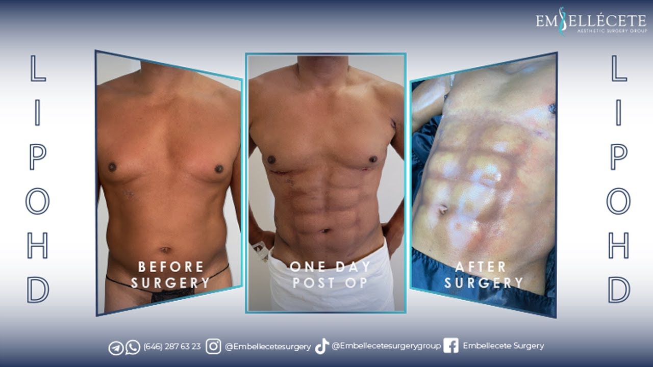 AMAZING LIPO HD - YouTube