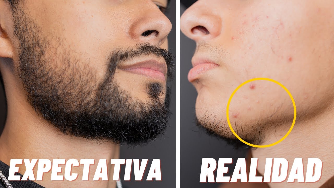 5 Razones Por Las Que Tu Barba No VE TUPIDA - YouTube