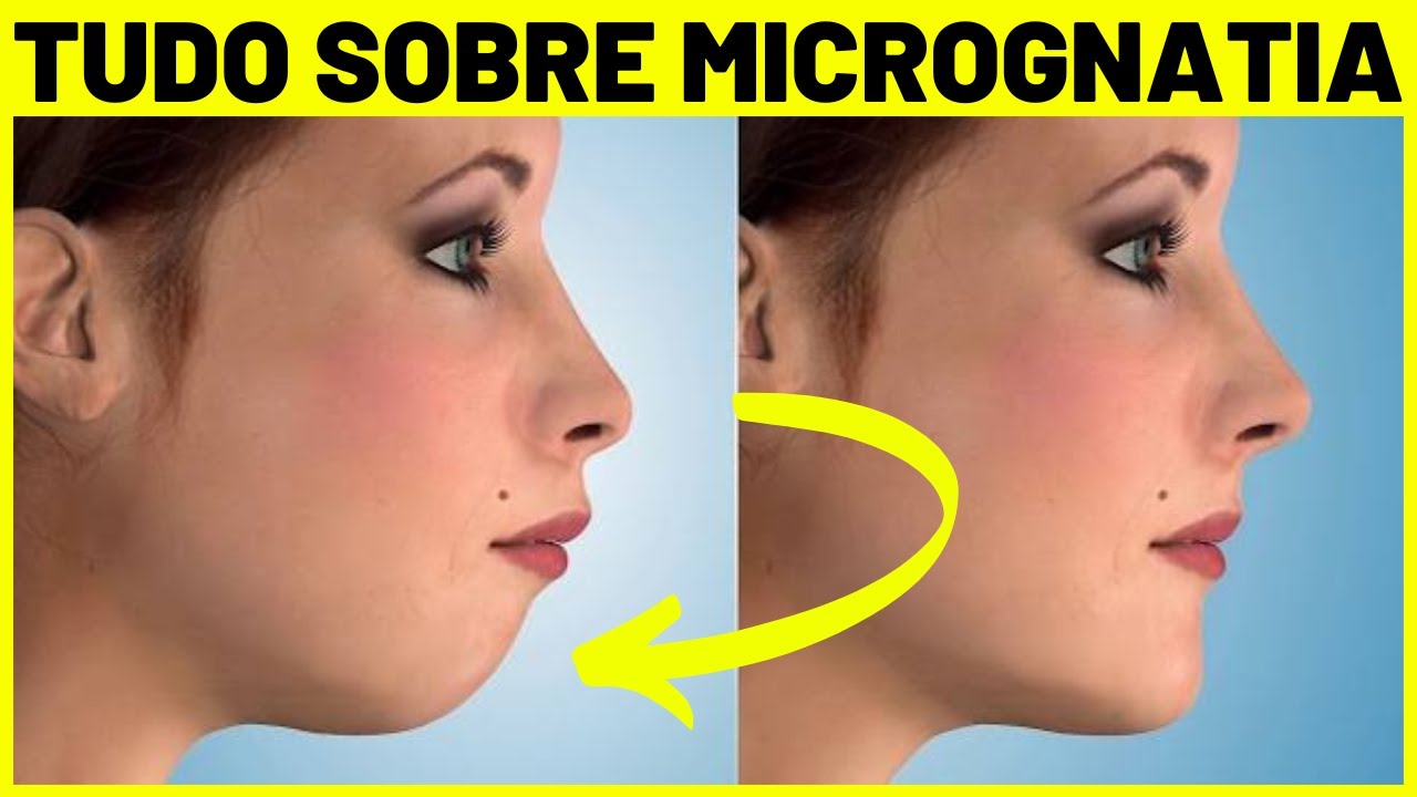 MICROGNATIA - O QUE É, CAUSAS, SINTOMAS E TRATAMENTO (mandíbula pequena ...