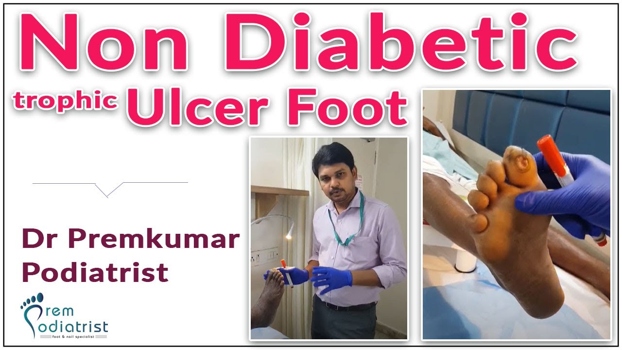 Non diabetic trophic ulcer foot. Dr.Premkumar (Podiatric surgeon) | Dr ...