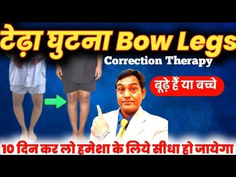 टेढ़ा घुटना कैसे ठीक करें ? Bow Legged Correction Exercises #bowlegs # ...