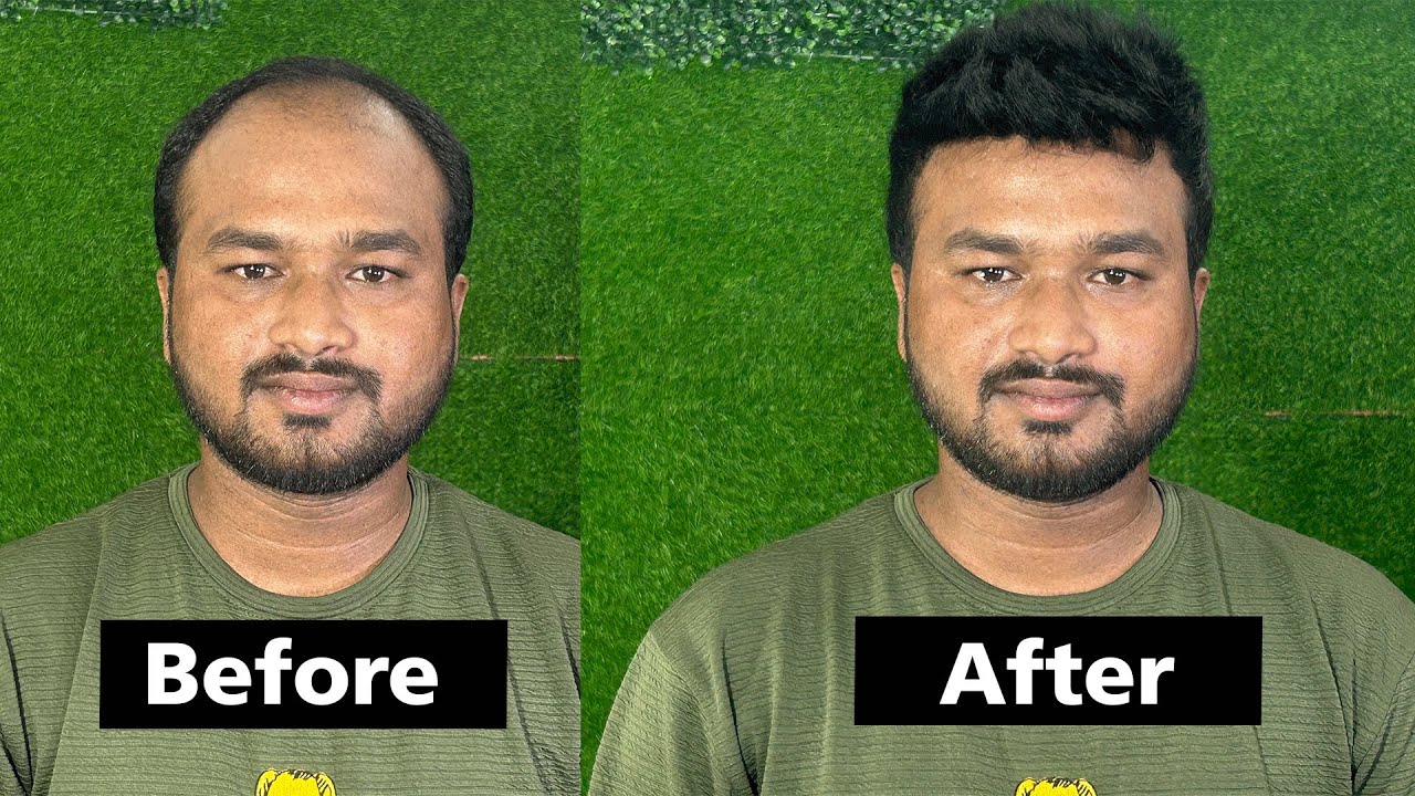 Non Surgical 🔥 Hair Replacement | Full Head of Hair in 30 Minutes ...