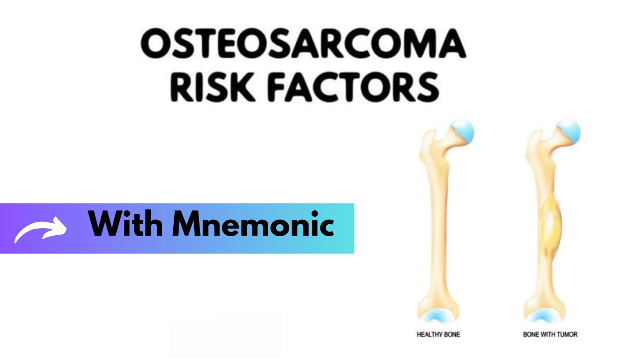Osteosarcoma Risk Factor Mnemonic | Surgery Mnemonics | Medicine ...