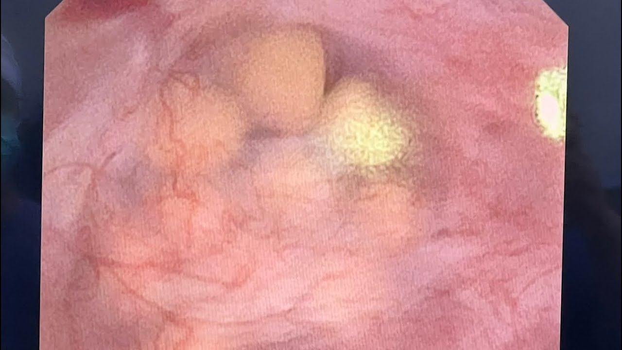 Calyceal Diverticulum Sponge Kidney Stones and Flexible URS, Dr.AlAdimi ...