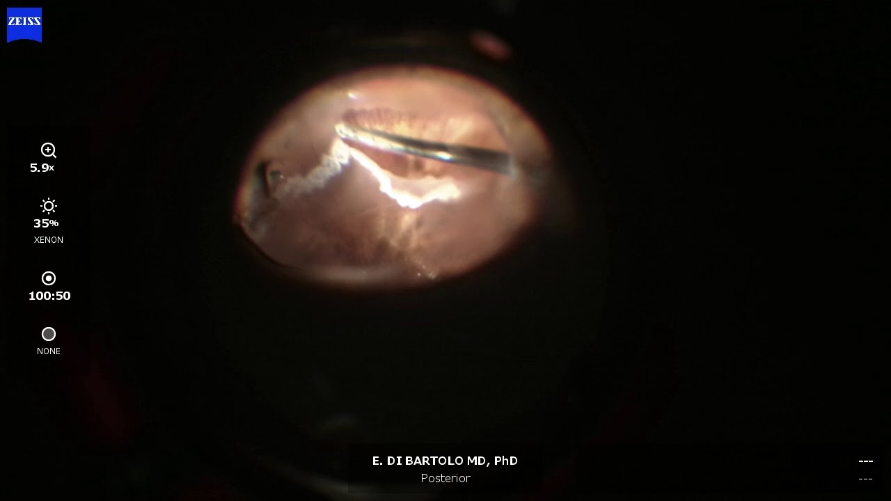 Complex retinal detachment surgery (subretinal band removal) - YouTube