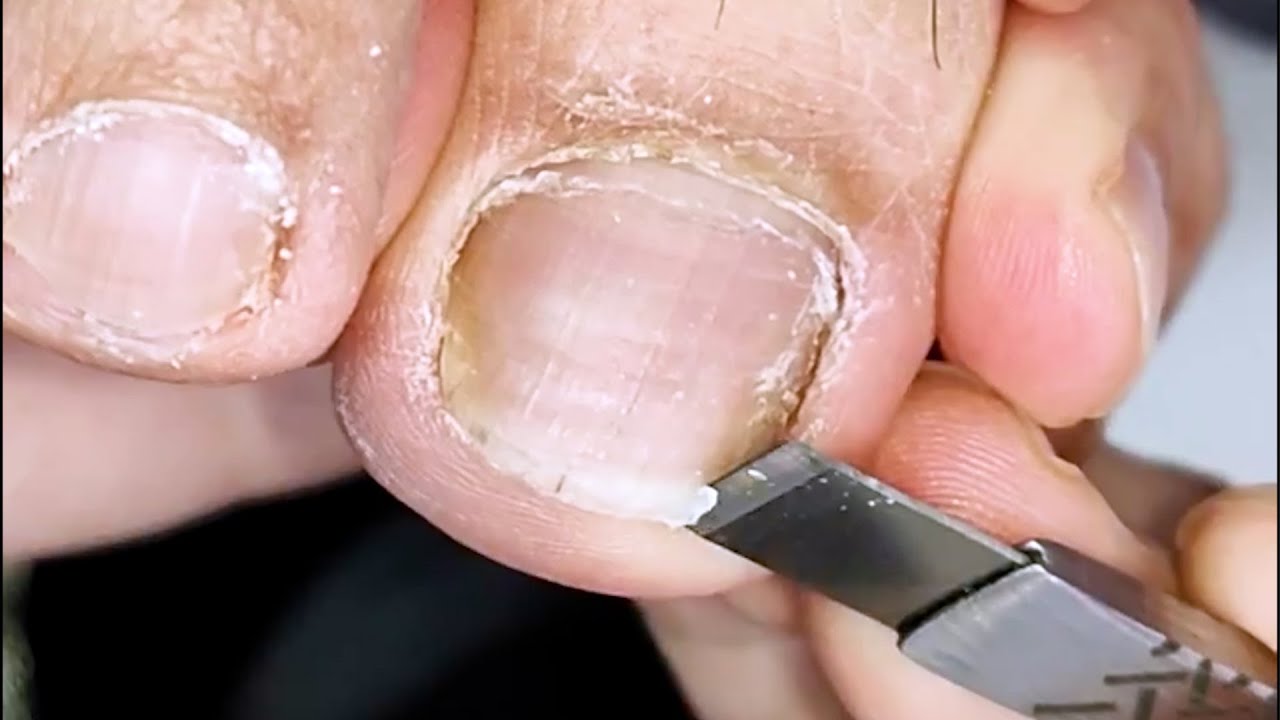 Incarnate nails on both sides of the fingernails - YouTube