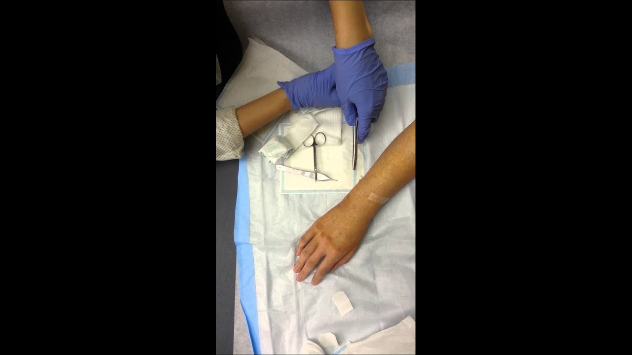 Successful K-Wire removal - YouTube