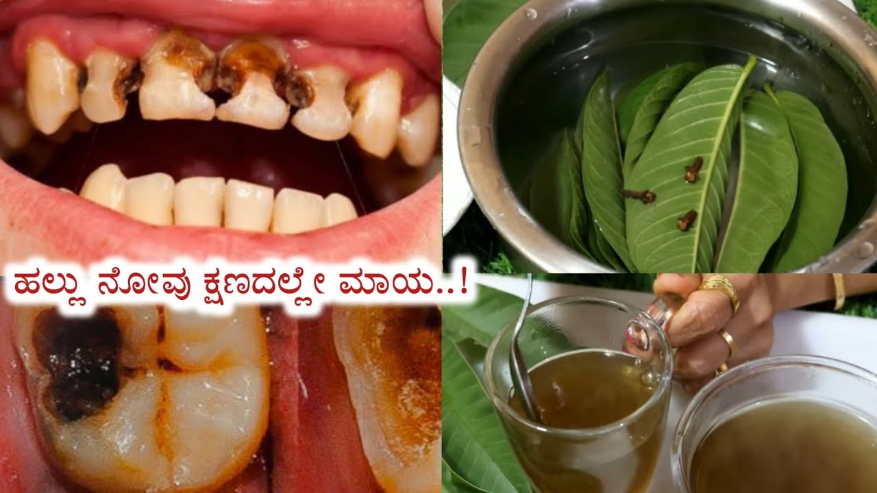 ಹಲ್ಲು ನೋವು,ಹಲ್ಲು ಹುಳು,ವಸಡುಗಳ ನೋವು ರಕ್ತ ಸಾವ್ರ ಏನೆ ಇರಲಿ ಈ ಎಲೆಯಿಂದ ಹೀಗೆ ...
