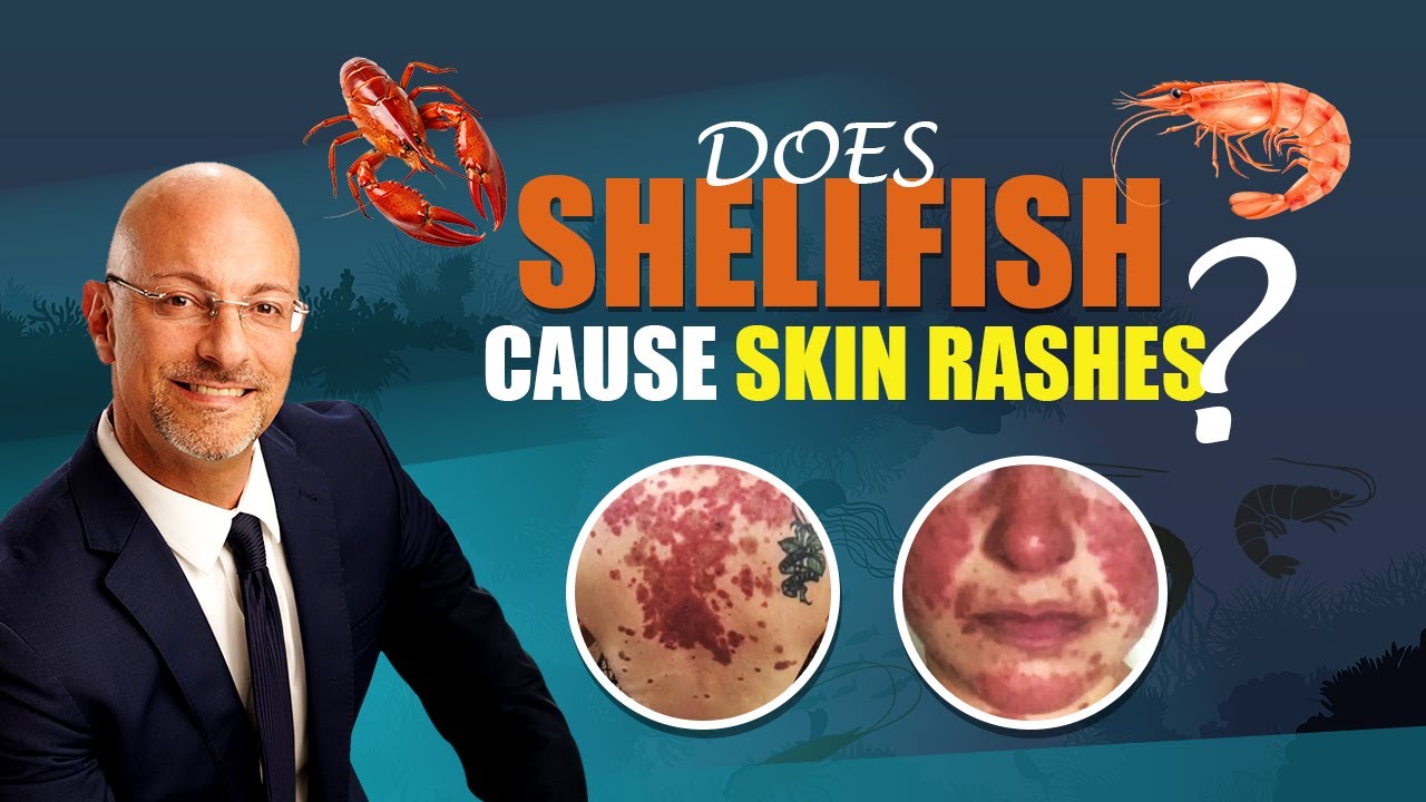 Does Shellfish Cause Skin Rashes?|| Dr Lonnie Herman - YouTube