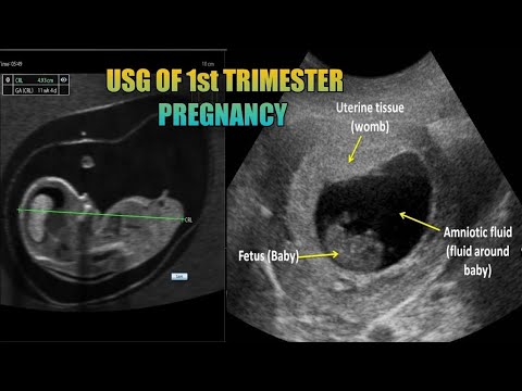 USG of 1st Trimester Pregnancy ||USG of pregnancy profile|| CMU ...