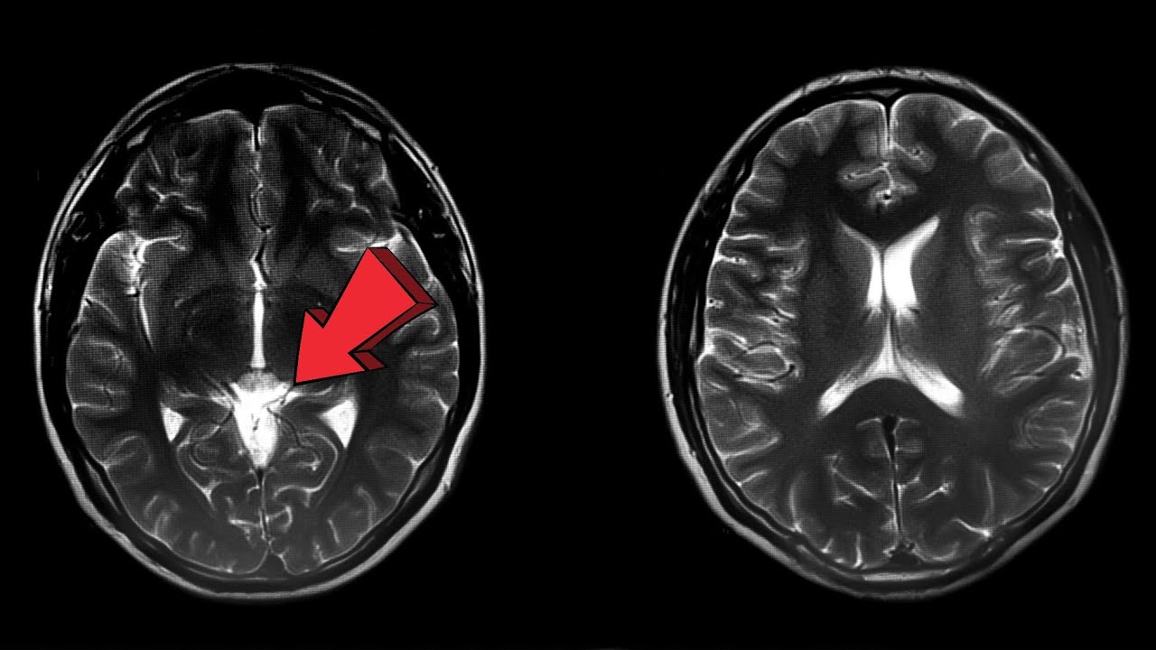 First Brain Scan of Dying Man Reveals a Unexpected Secret ! - YouTube