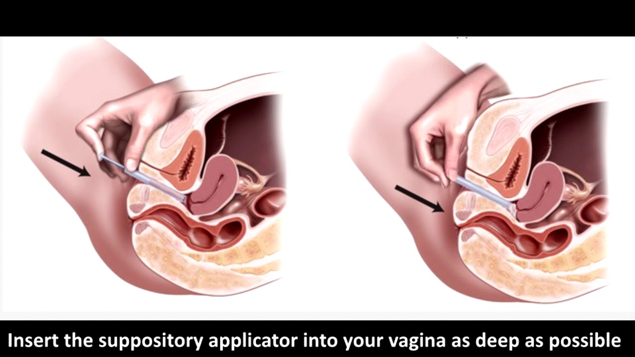 How to use suppository by applicator - YouTube