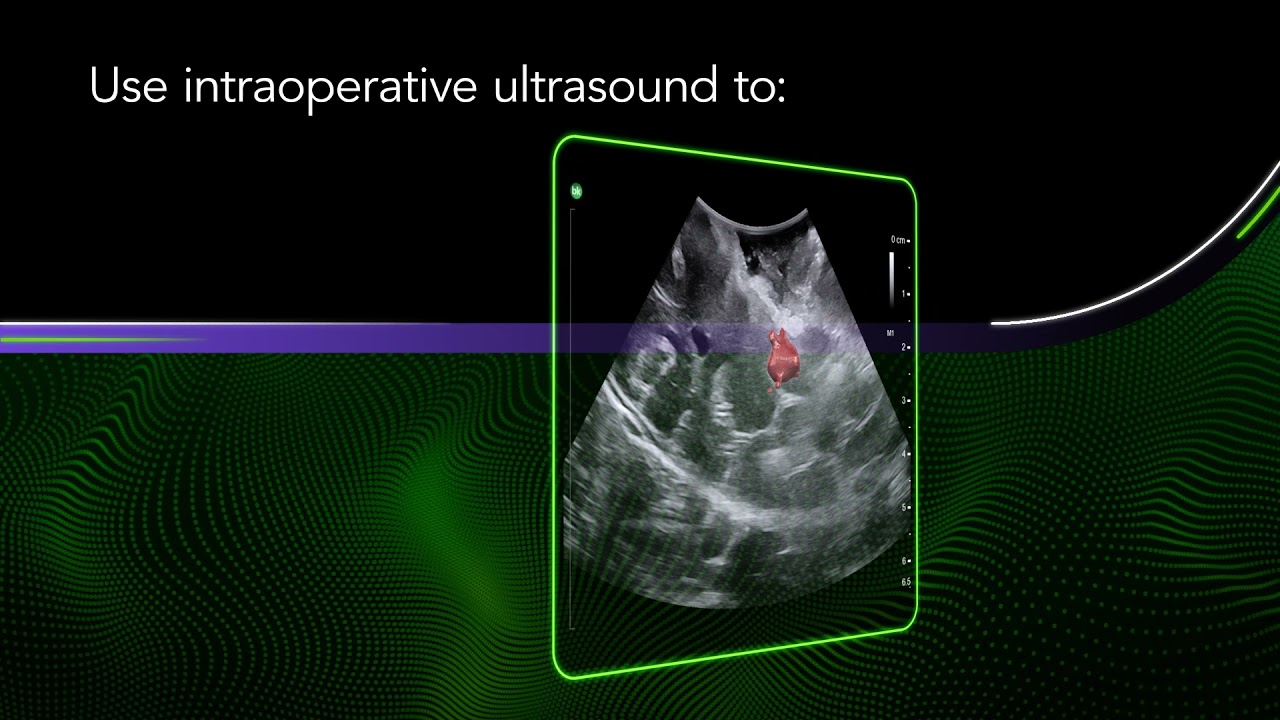 bkActiv for Hematoma Video - YouTube