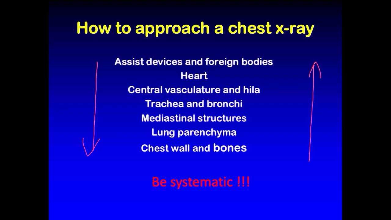 Reading a Chest X-ray - YouTube