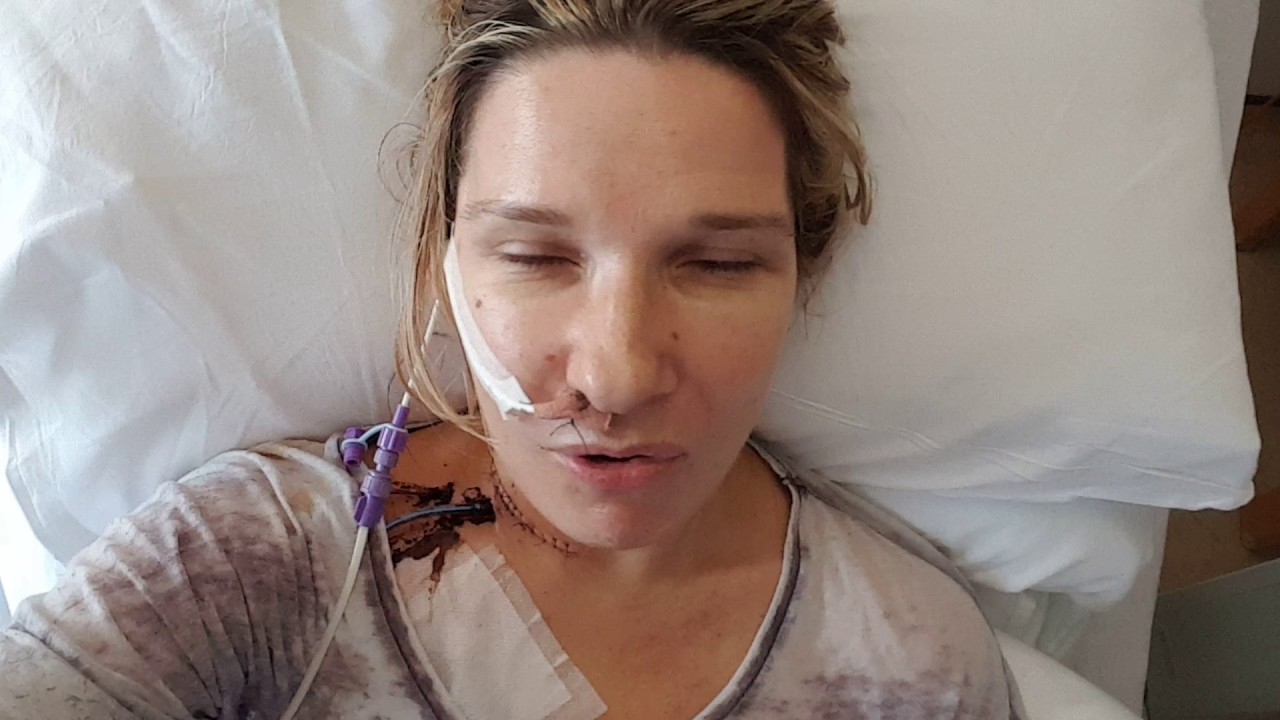 Mouth Cancer Charlie Rees 3 days Post Op Swollen - Diary 9 - YouTube