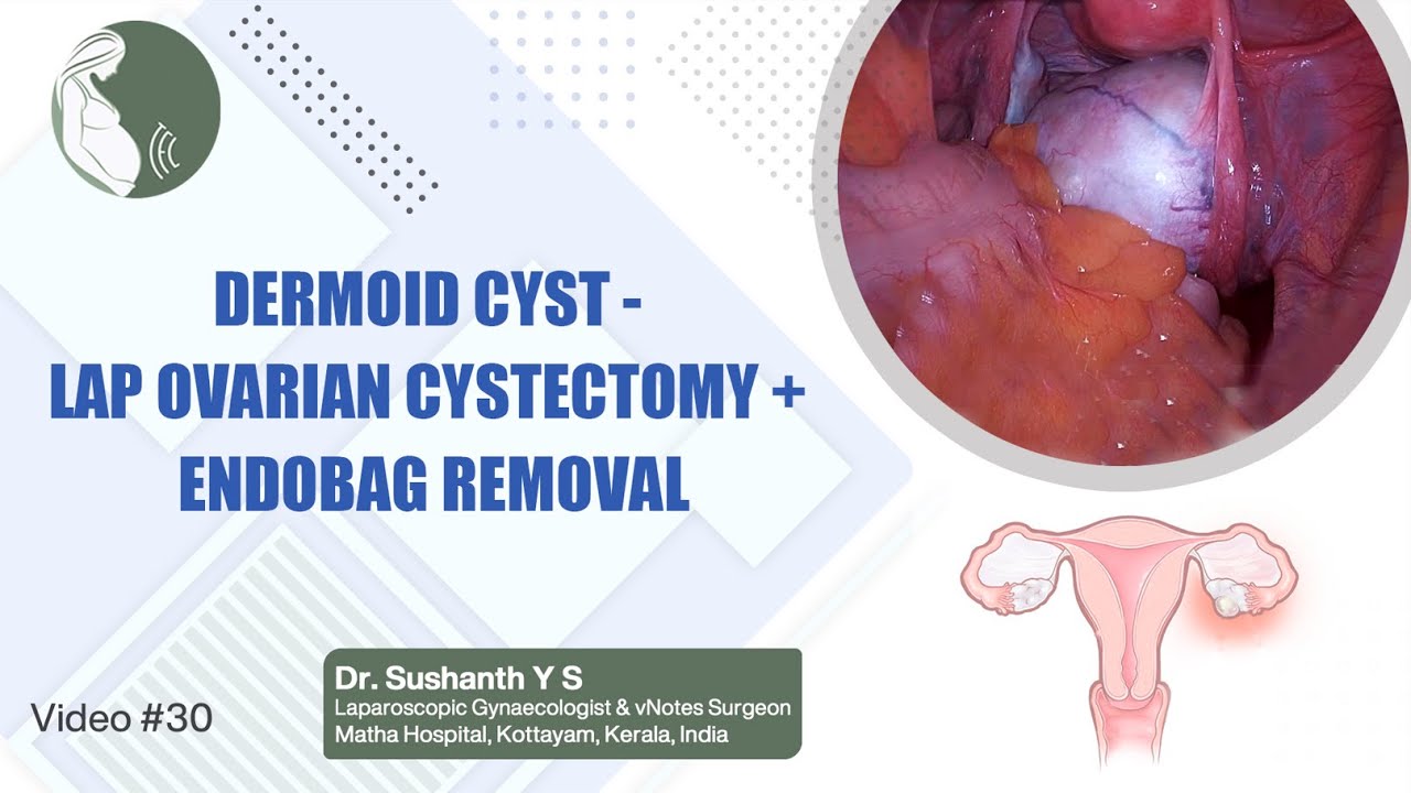 DERMOID CYST - LAP OVARIAN CYSTECTOMY & ENDOBAG REMOVAL - YouTube