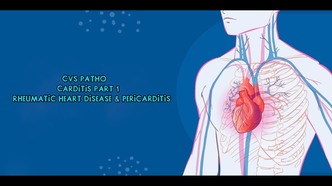 CVS Patho - Carditis part 1 ( rheumatic heart disease & Pericarditis ...
