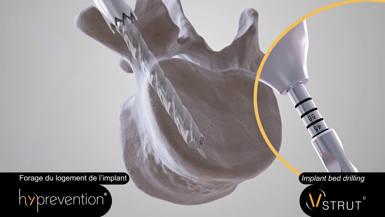V-STRUT Vertebral Implant Tech-Op by Hyprevention - YouTube