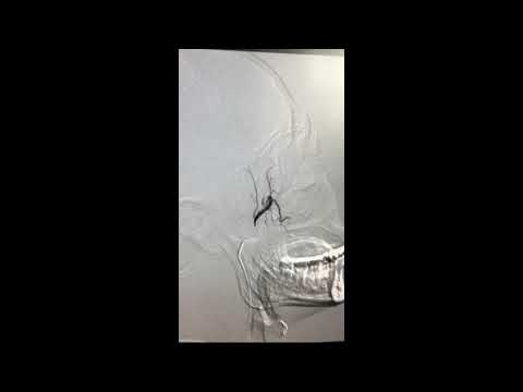 Treatment of intractable nasopharyngeal hemorrhage after NPC - Supplementary video 1 [ID 283968]