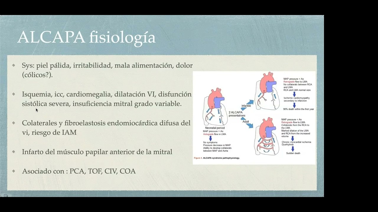Opciones de manejo quirúrgico de ALCAPA - YouTube
