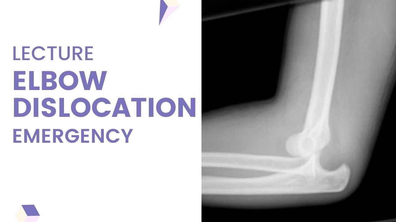 Elbow Dislocation - Causes, Diagnosis and Treatment - Detailed ...