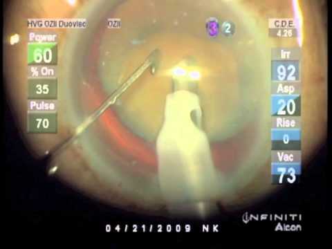 Morgagnian Cataract - YouTube