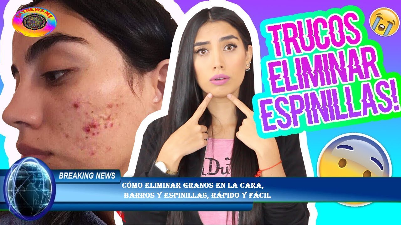 Cómo eliminar granos en la cara, barros y espinillas, rápido y fácil ...