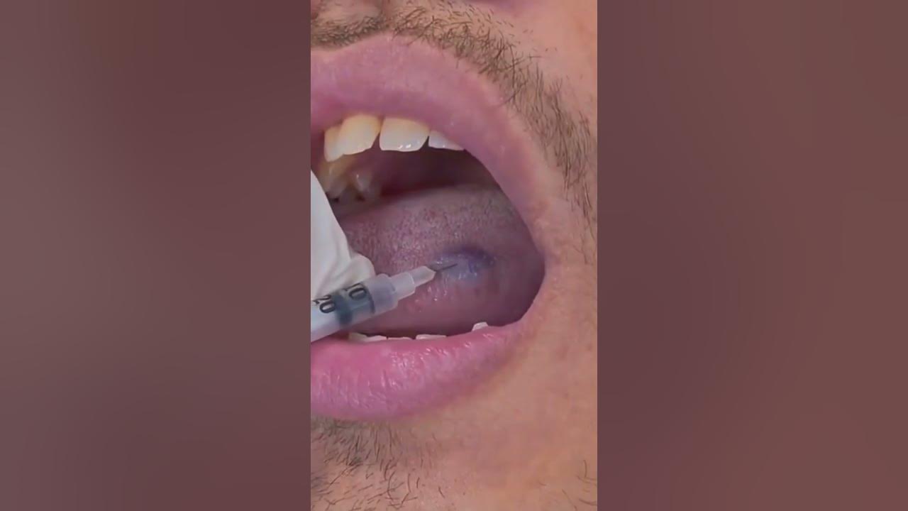 Puncture In Vascular Malformation In Front Of Tongue Vm Abscess