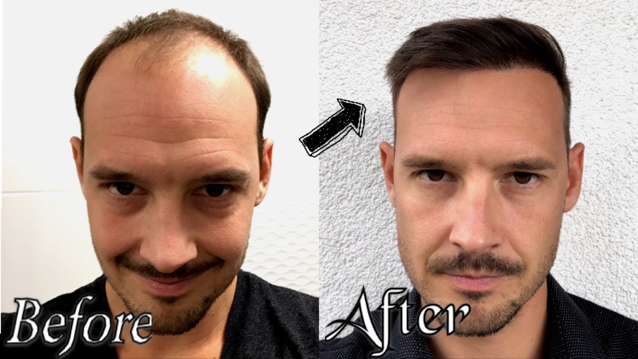 Haarausfall Männer - Für mich war eine Haartransplantation der richtige ...