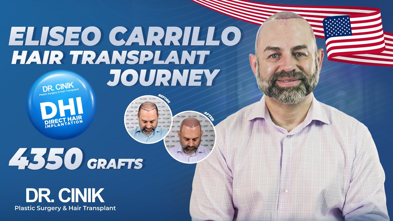 Eliseo Carrillo | DHI 4350 Grafts| Hair Transplant Journey | Dr. Cinik ...