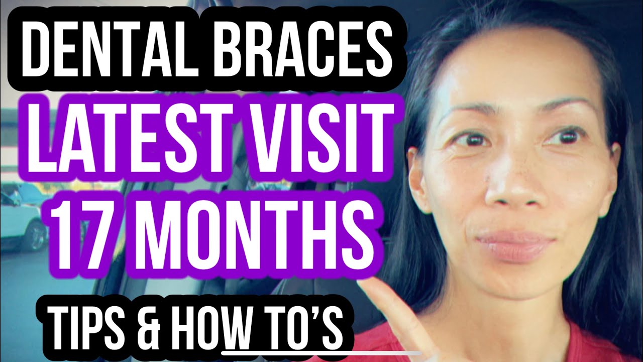 DENTAL BRACES: 17 Months Visit - YouTube