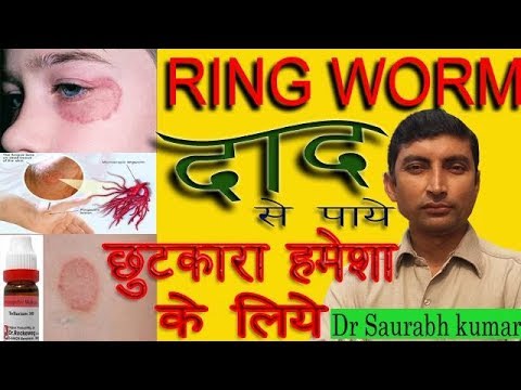 RING WORM !! Homeopathic medicine for RINGWORM ,दाद का होम्योपैथिक ...