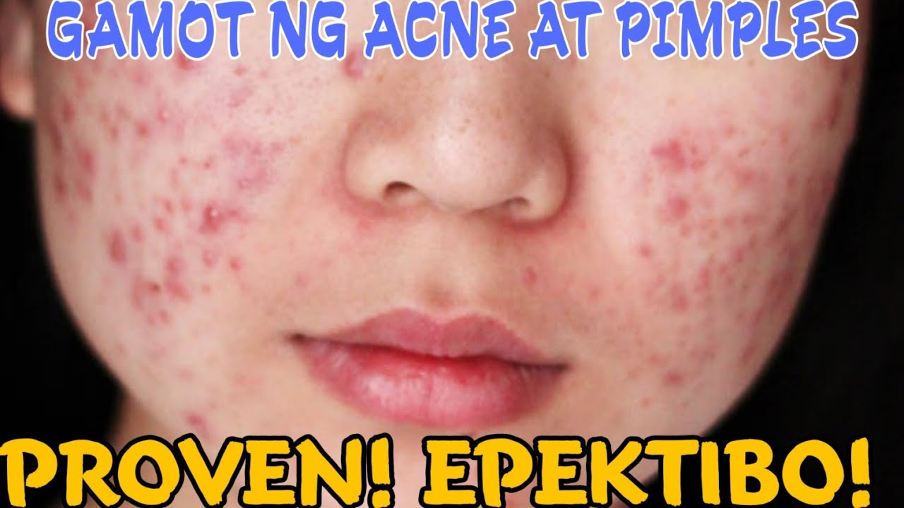 RECOMMENDED NA MGA GAMOT SA ACNE AT PIMPLES - YouTube