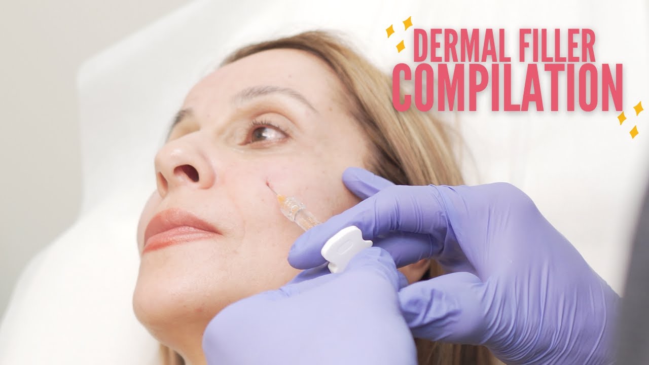 Dermal Filler Time Lapse Compilation! 😁💉 - YouTube