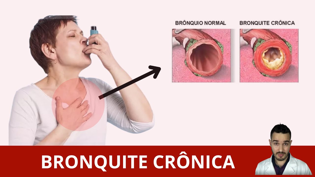 Bronquite Aguda Prevent Senior É Preciso Identificar As Causas Com