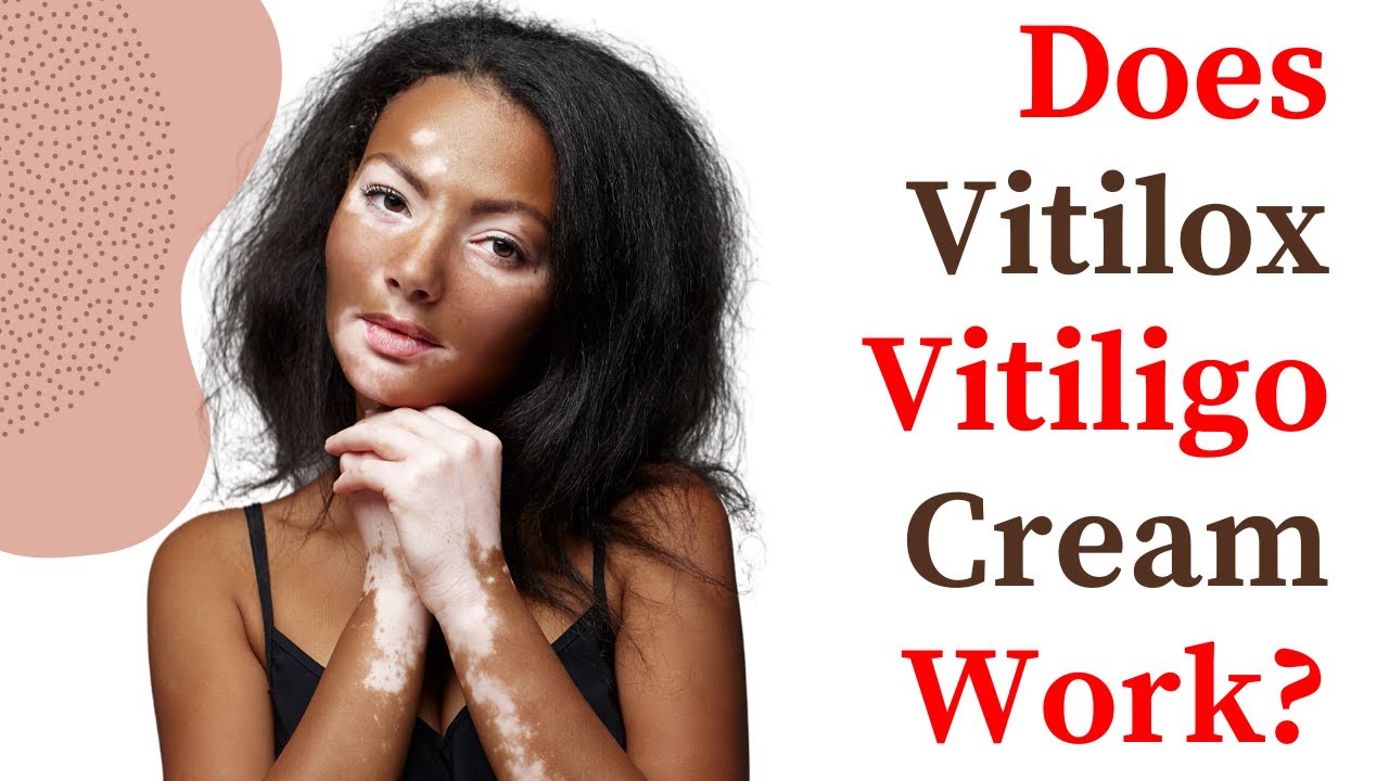 The Ultimate Vitiligo Treatment Pigmentation Cream - Rejuvenate your ...