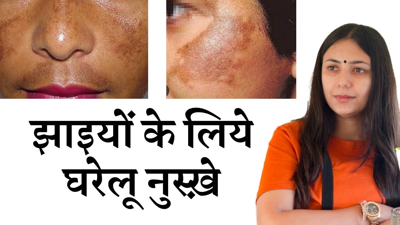 Jhaiyo Pimple Acne ke liye gharelu nuskhe | Pigmentation Melasma Home ...